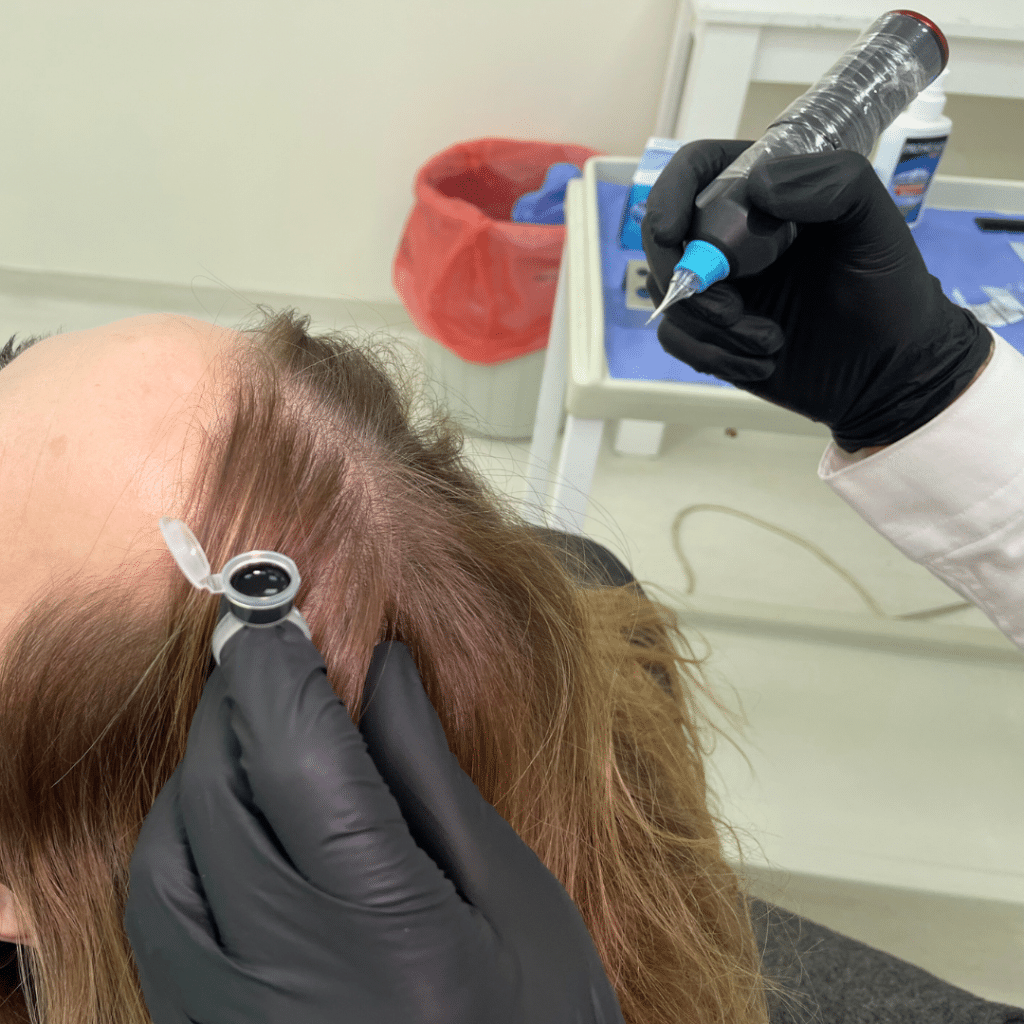 SMP and HIV-Related Hair Loss | SHIFT Hair