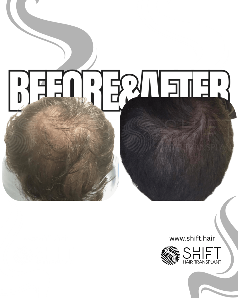 Hair PRP Platelet-Rich Plasma Istanbul Turkey Costs Results