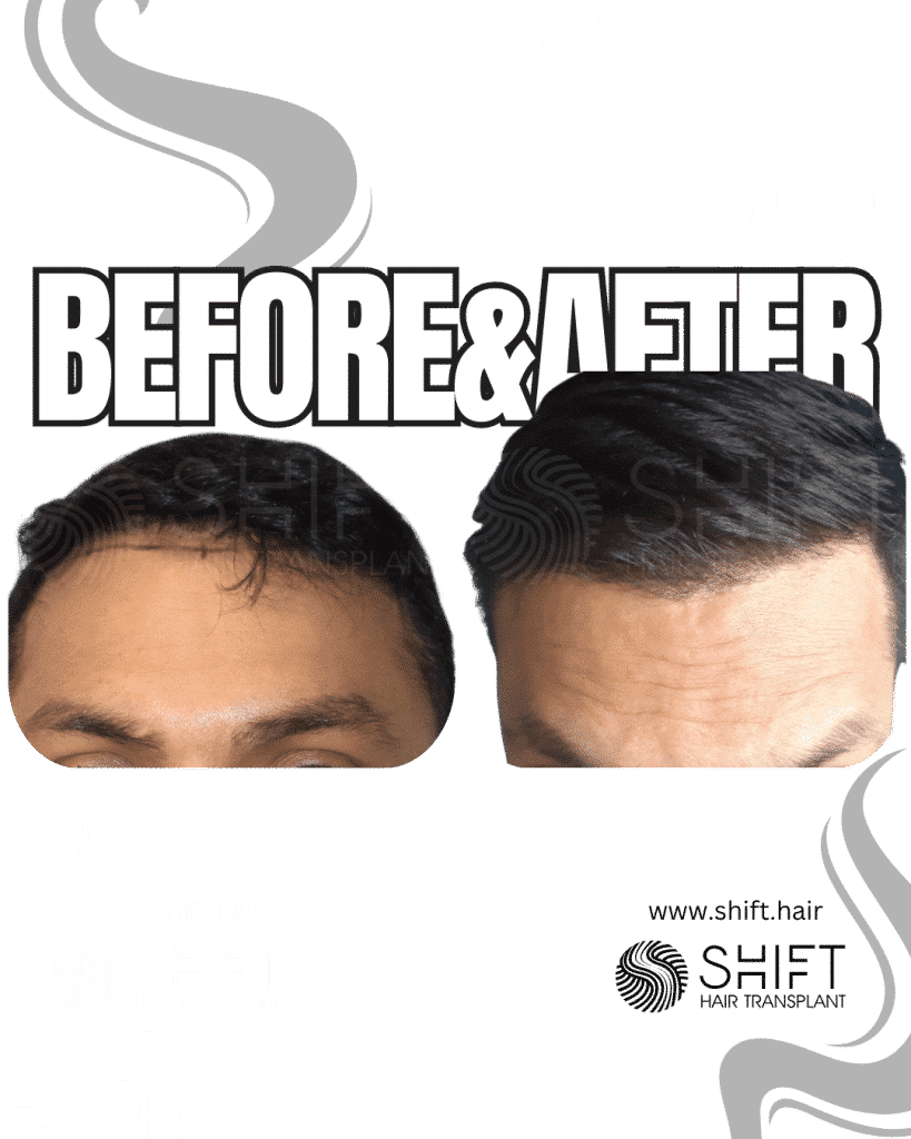 Hair Transplant in Turkey Istanbul | Costs and Results