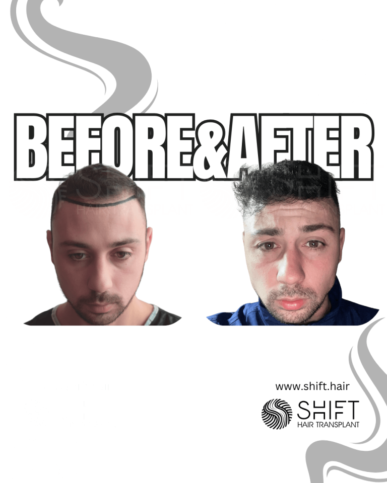 Hair Transplant in Turkey Istanbul | Costs and Results
