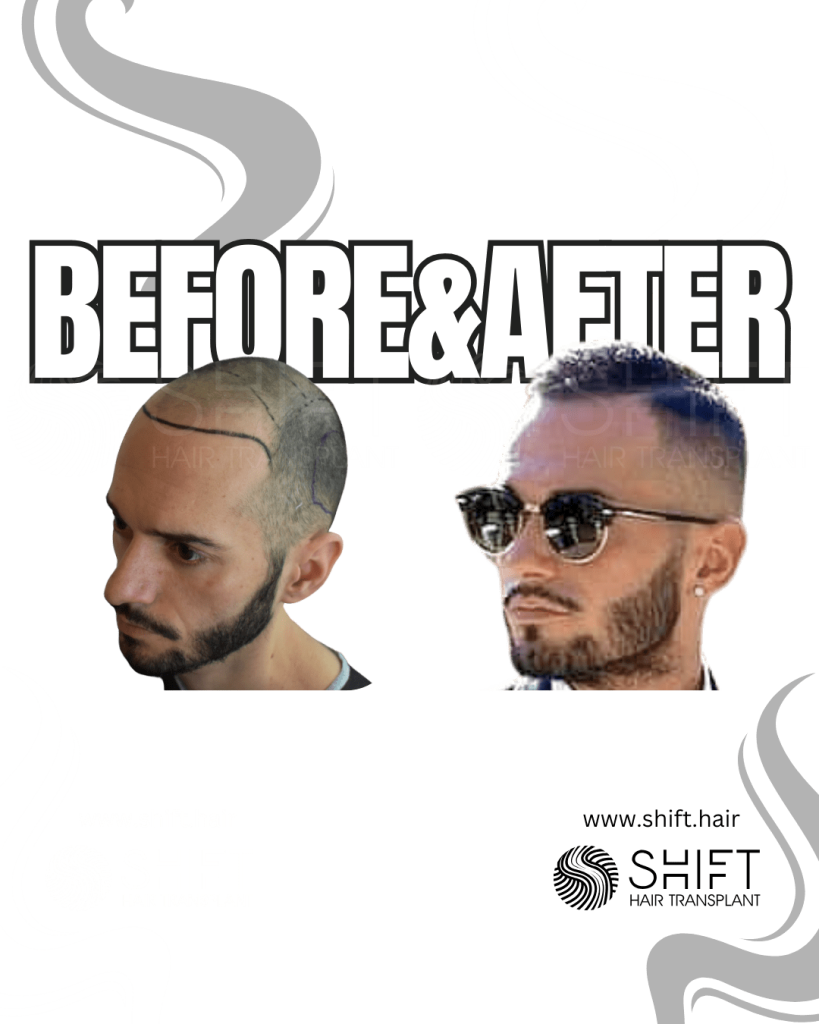 Hair Transplant in Turkey Istanbul | Costs and Results