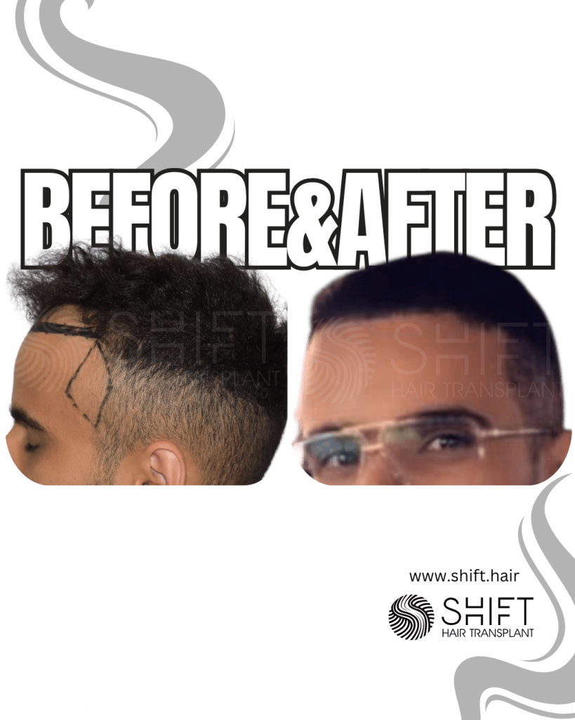 Temporal Triangles Hair Transplant Turkey Before After SHIFT Hair ...
