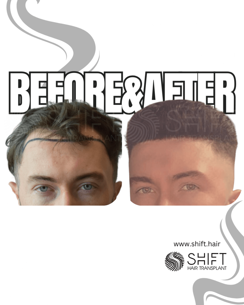 SHIFT Hair Transplant Turkey Results
